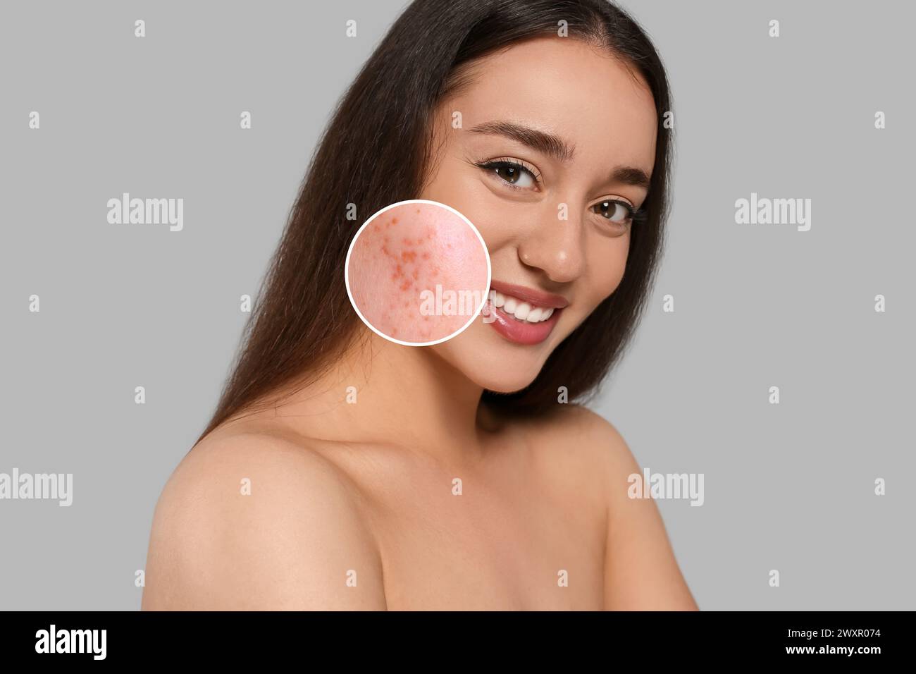 Woman skin rash happy hi-res stock photography and images - Alamy