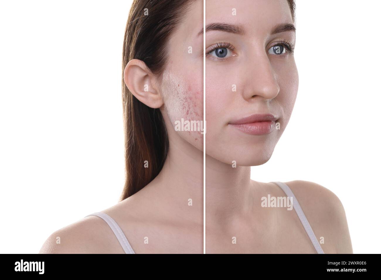 Acne problem, collage. Photo of woman divided into halves before and ...
