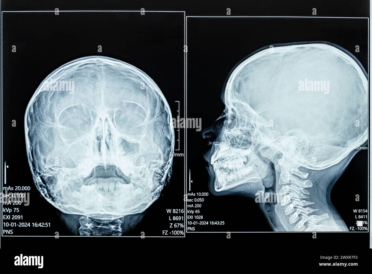 Child's 8 y.o. Skull X-ray: Side and Front Views Stock Photo - Alamy