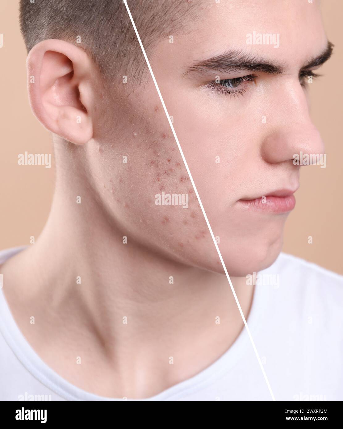 Acne problem, collage. Photo of man divided into halves before and ...