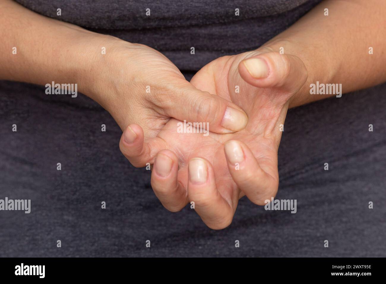 Woman hands showing numb hand Stock Photo - Alamy
