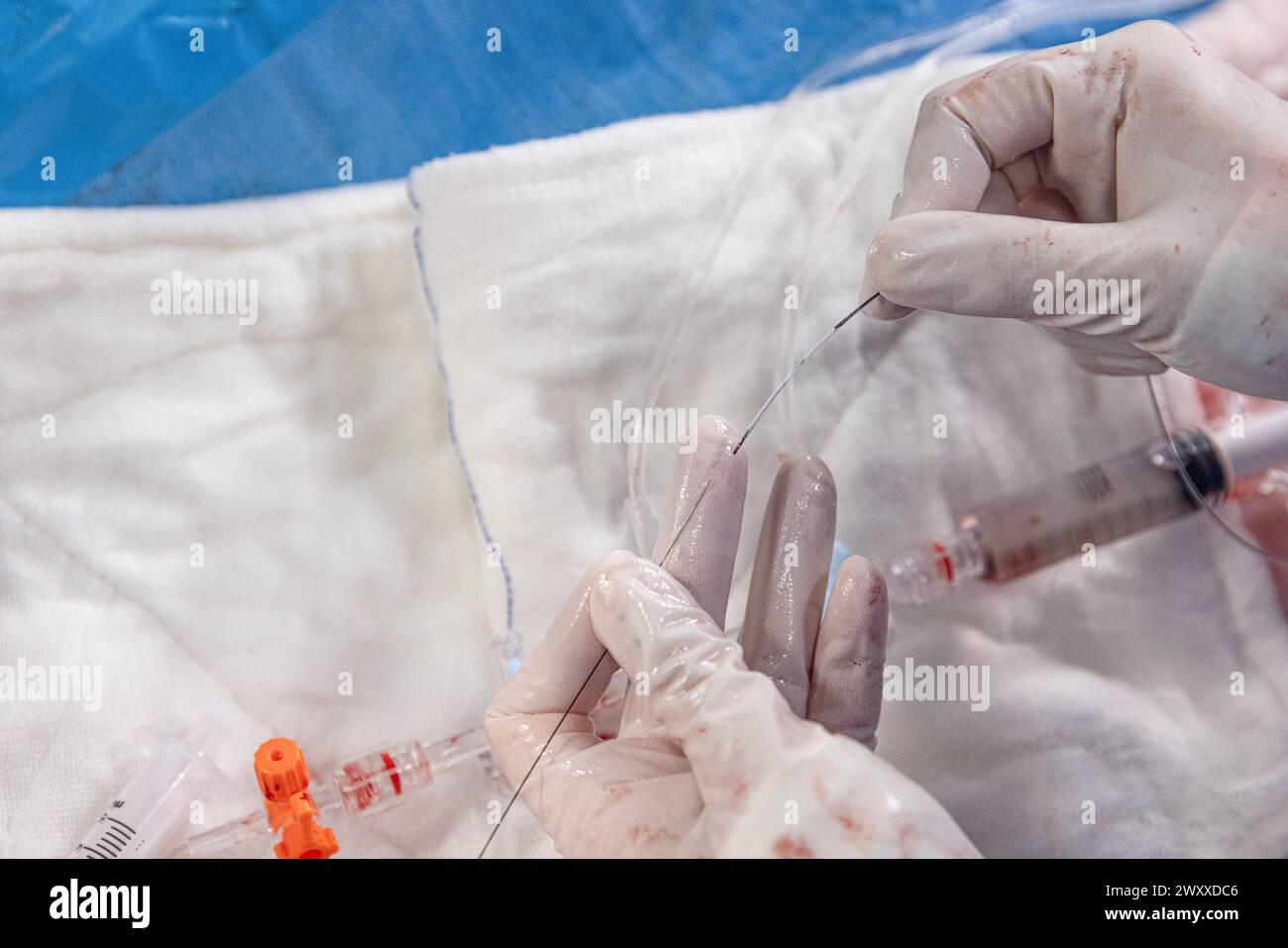 Interventional cardiology. Surgeon doctor at operation. Stent and ...