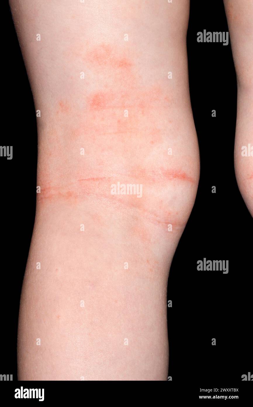 Eczema on the inner elbow of a 2 year old female patient. Eczema, also ...