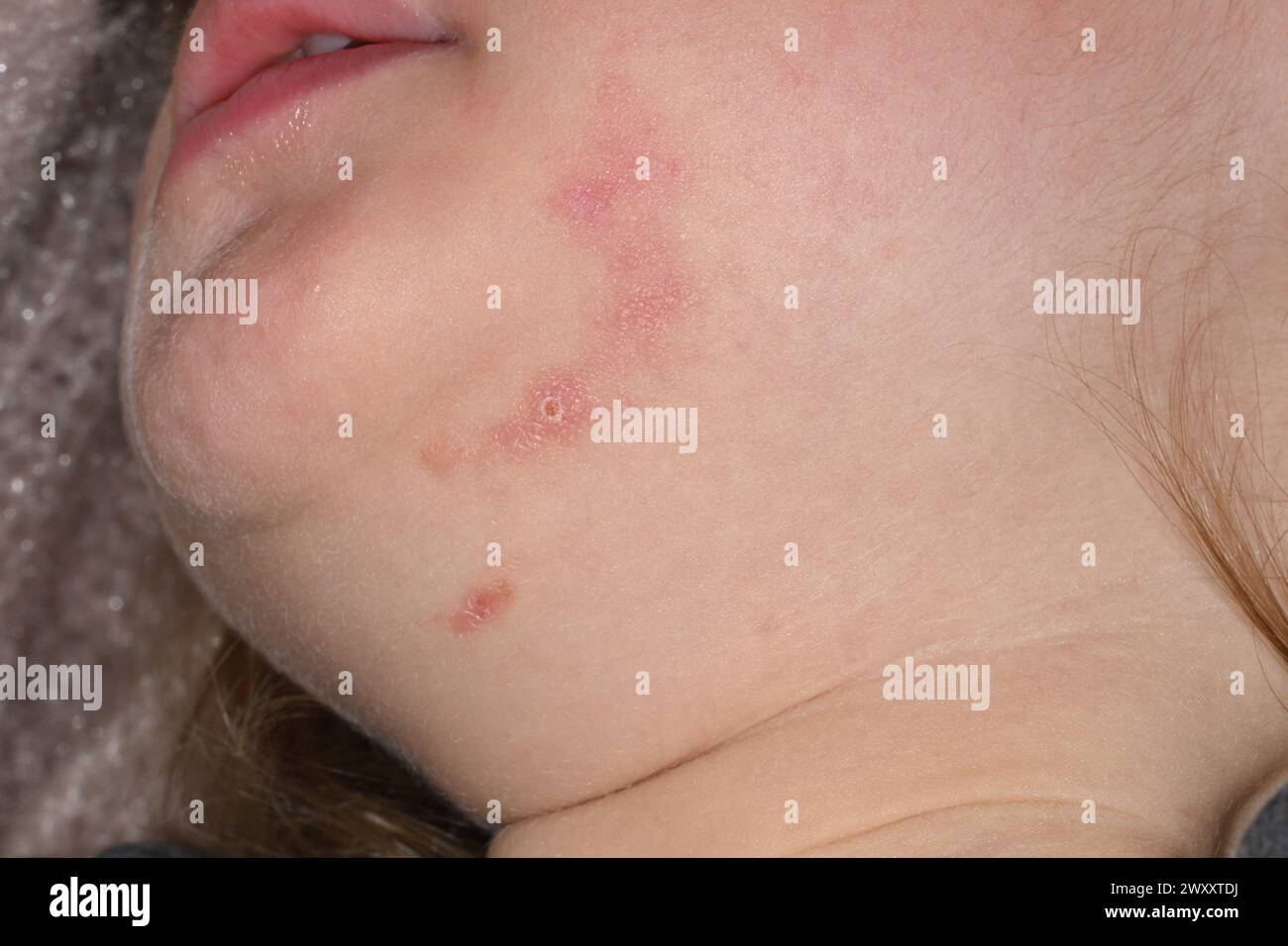 Cutaneous larva migrans (CLM) infection on the chin of a 2 year old ...
