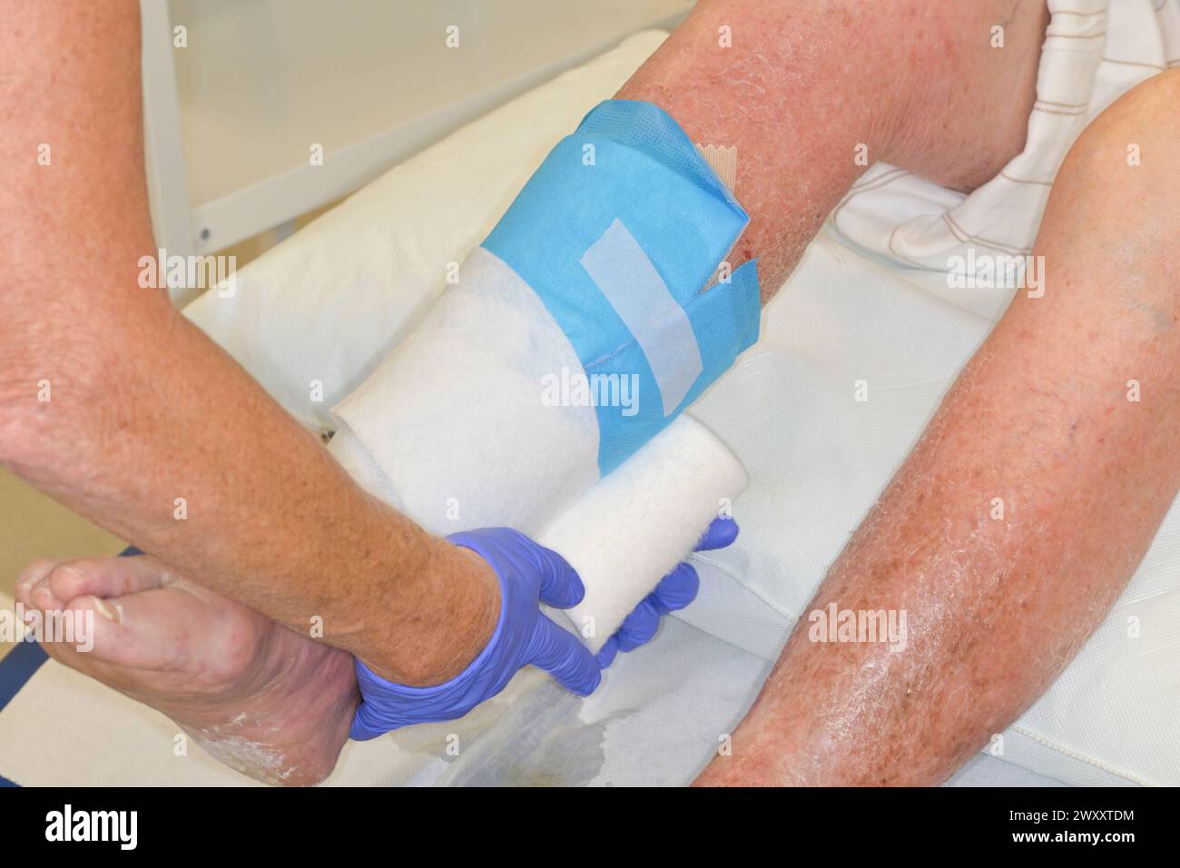 Leg dressing in a patient with varicose eczema and an ulcer on the back ...
