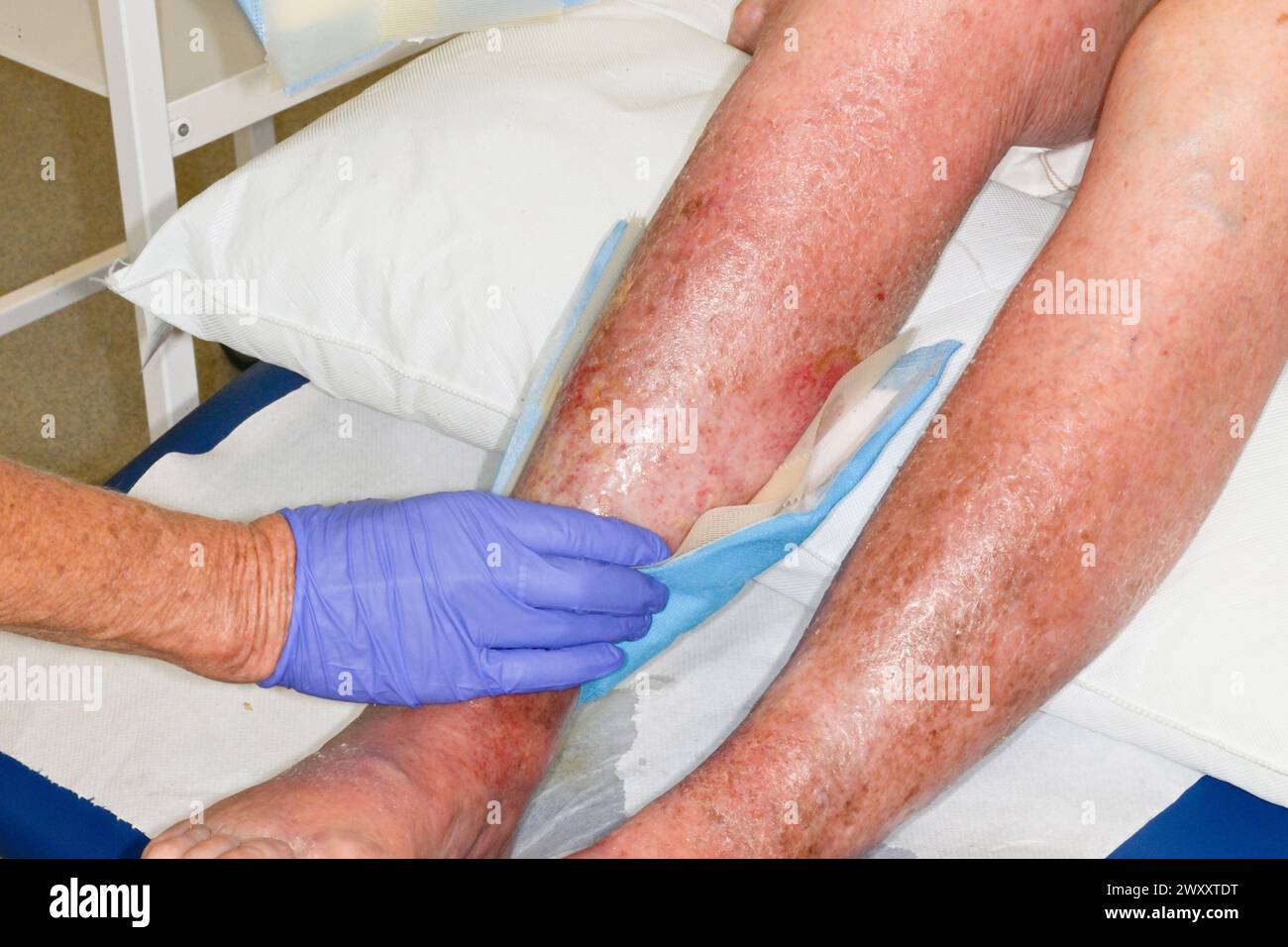 Leg dressing in a patient with varicose eczema and an ulcer on the back ...