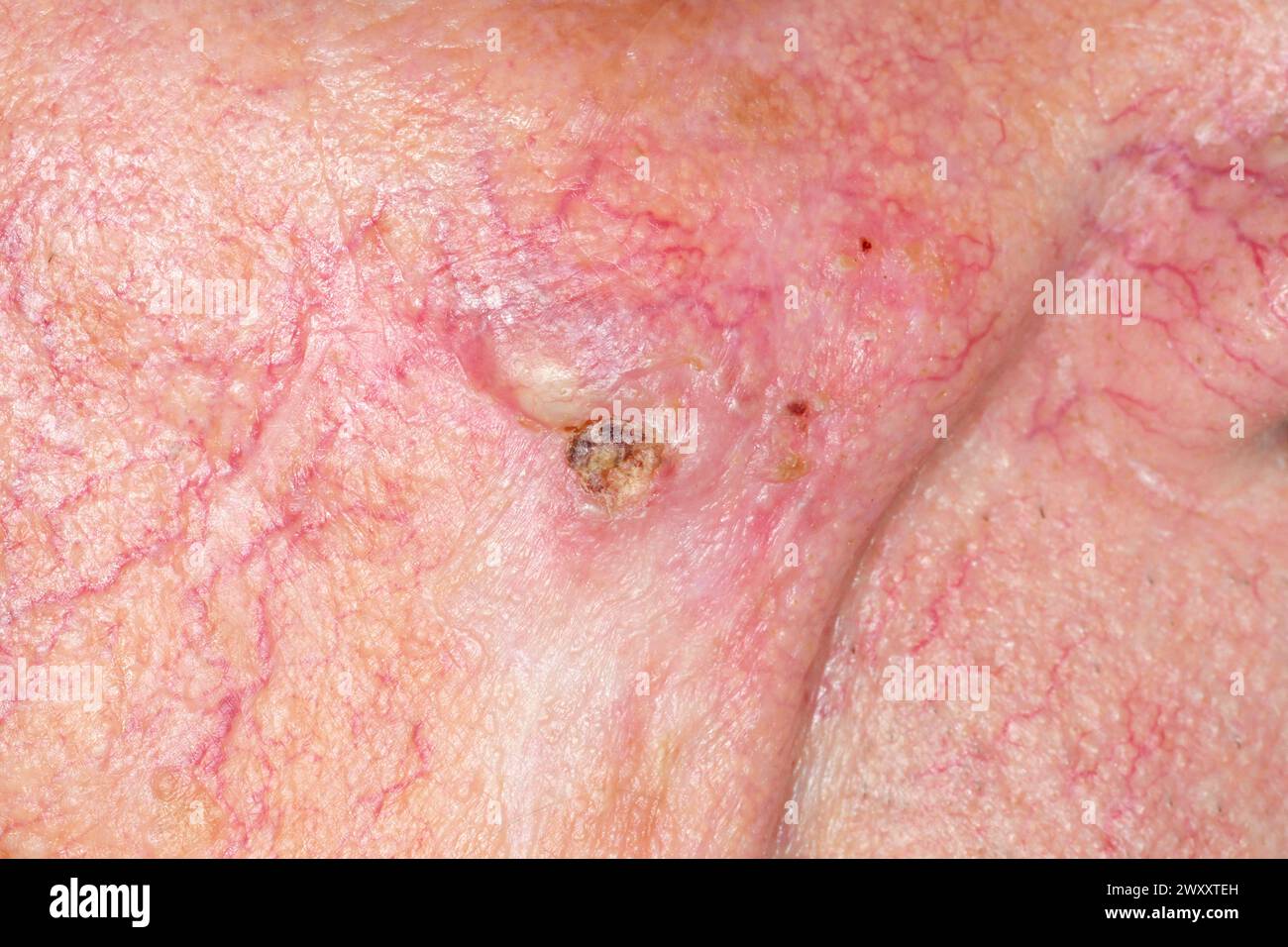 Basal cell carcinoma (BCC) on the cheek of a 86 year old female patient ...