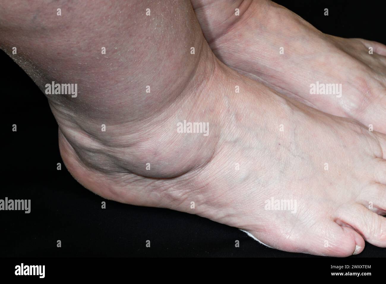 Ganglion cyst on the ankle of a 61 year old female patient Stock Photo ...