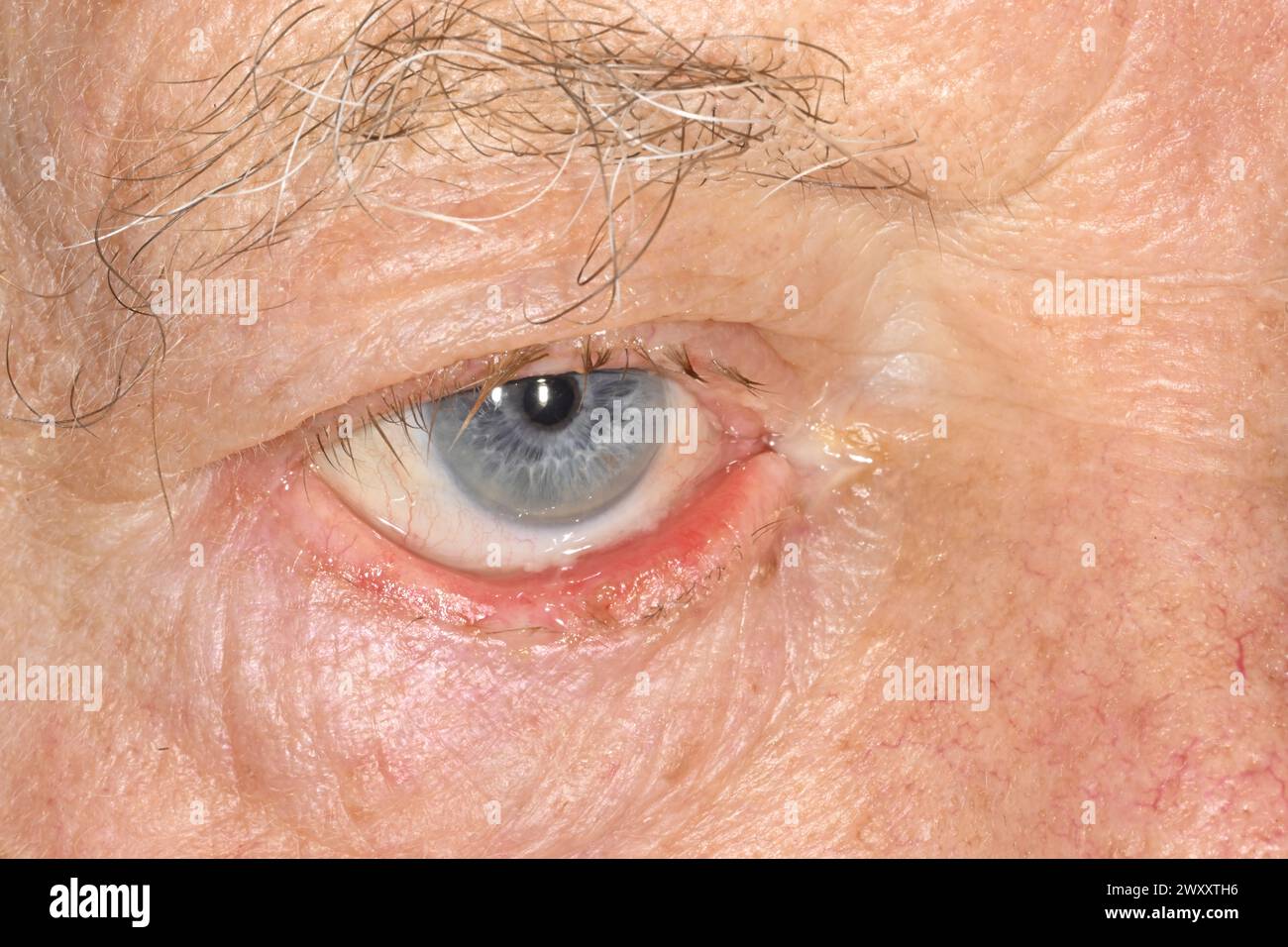 Ectropion in an 86 year old male patient. This is a condition in which ...