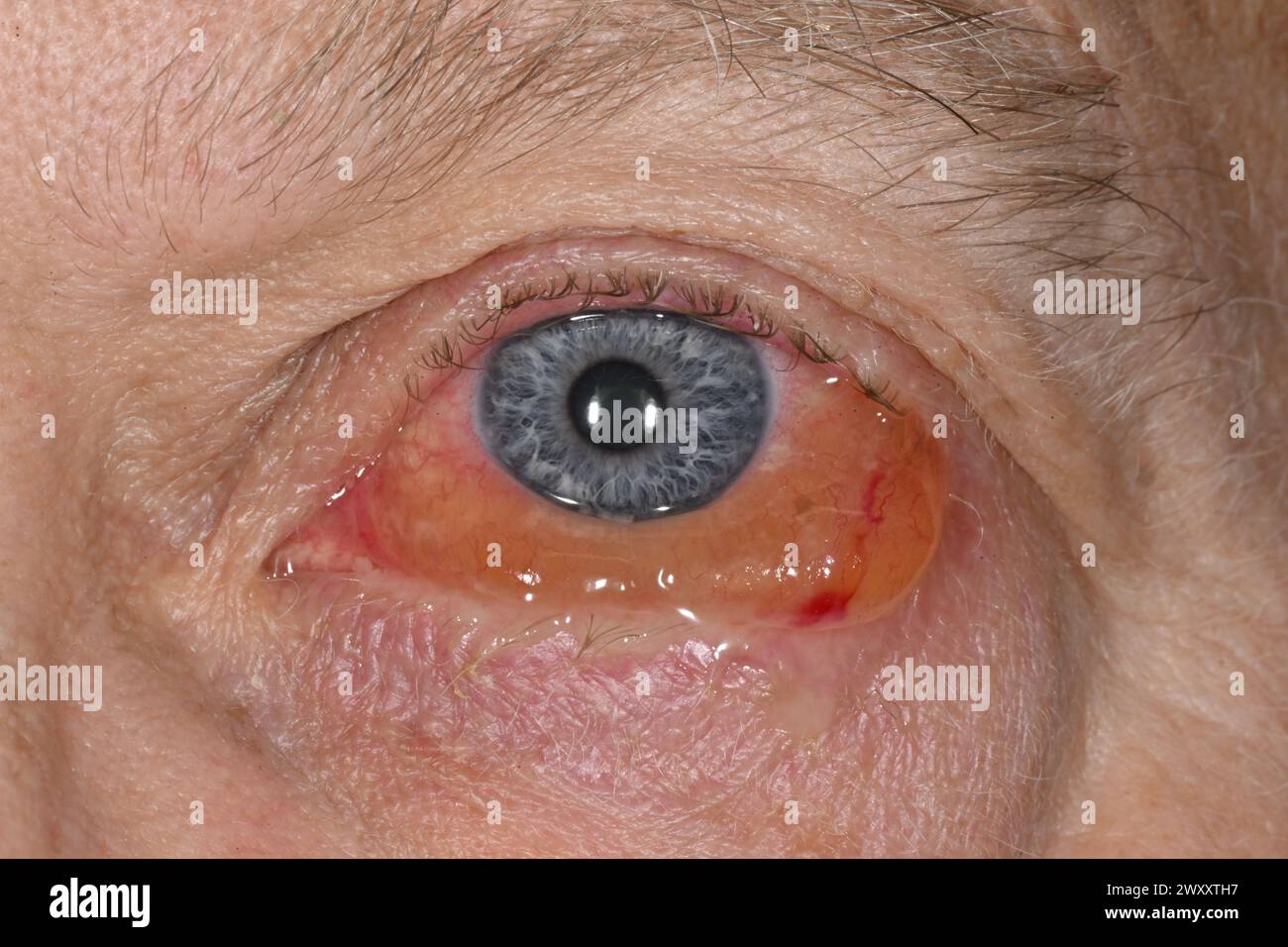 Conjunctival oedema in the eye of a 57 year old male patient. The white ...