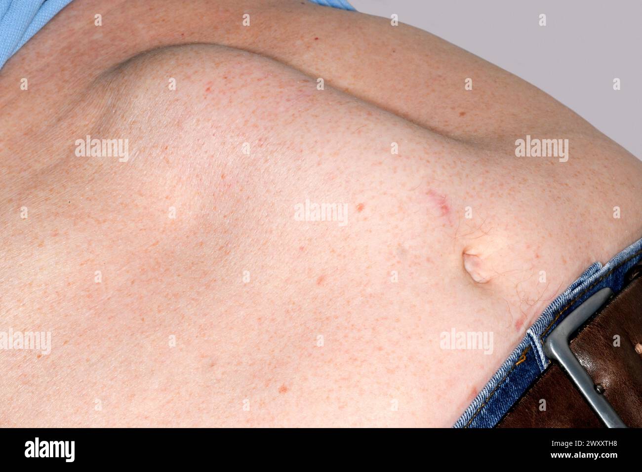 Spreading apart (divarication) of the abdominal recti muscles in a 73 ...