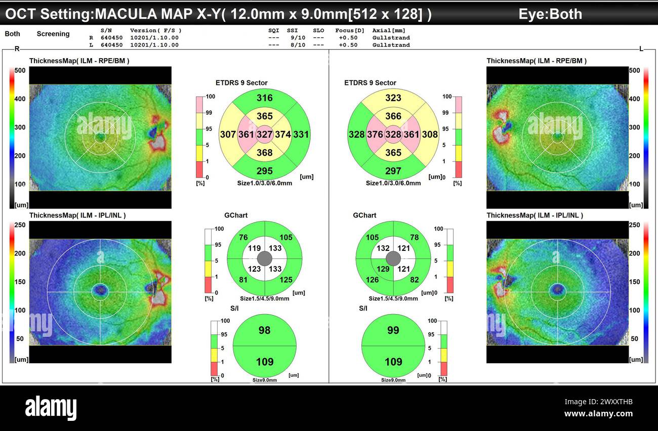 Optical coherence tomography (OCT) retinal thickness maps of healthy ...
