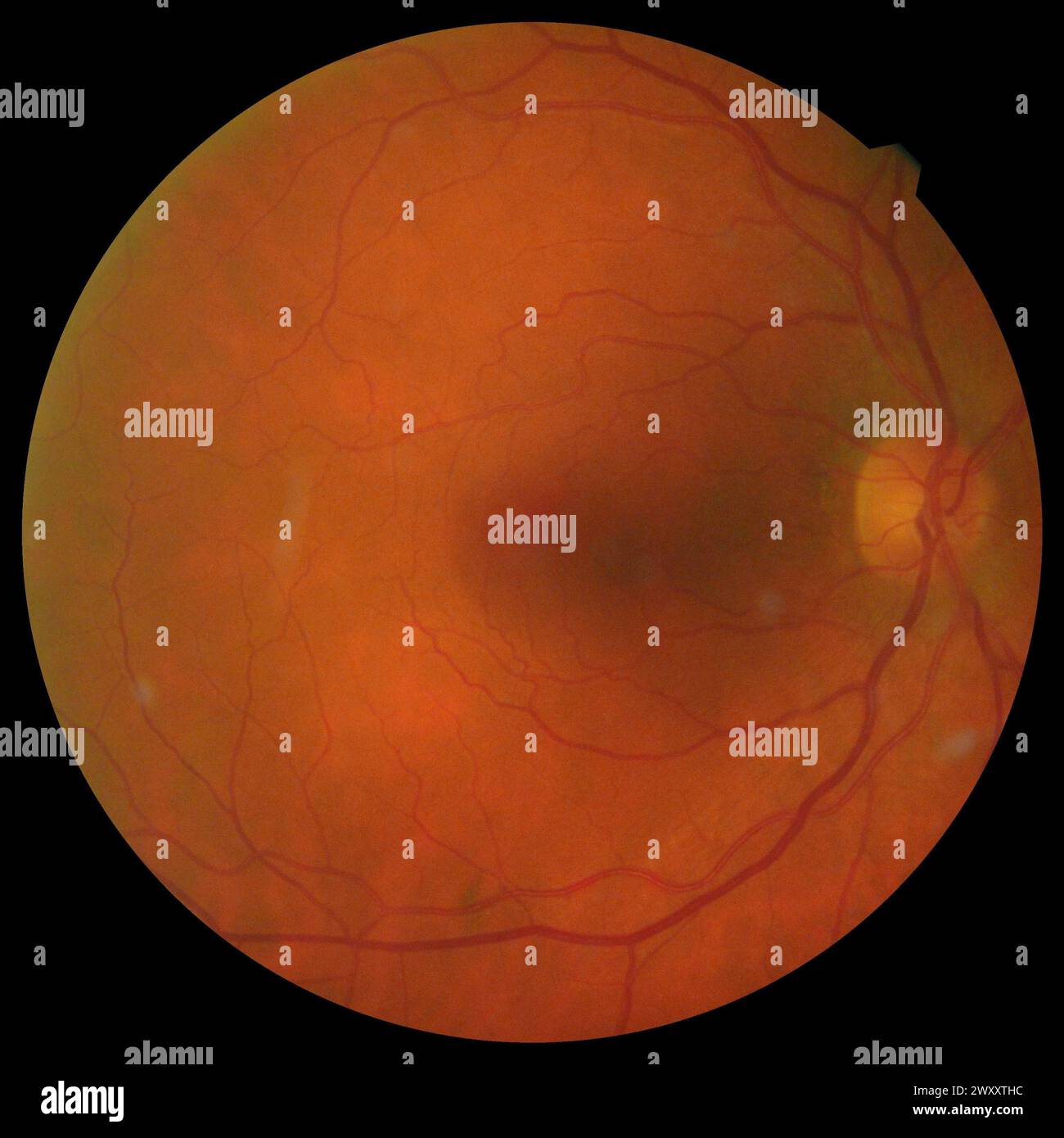 Fundoscopy scan of a healthy eye in a 63 year old female patient. The ...