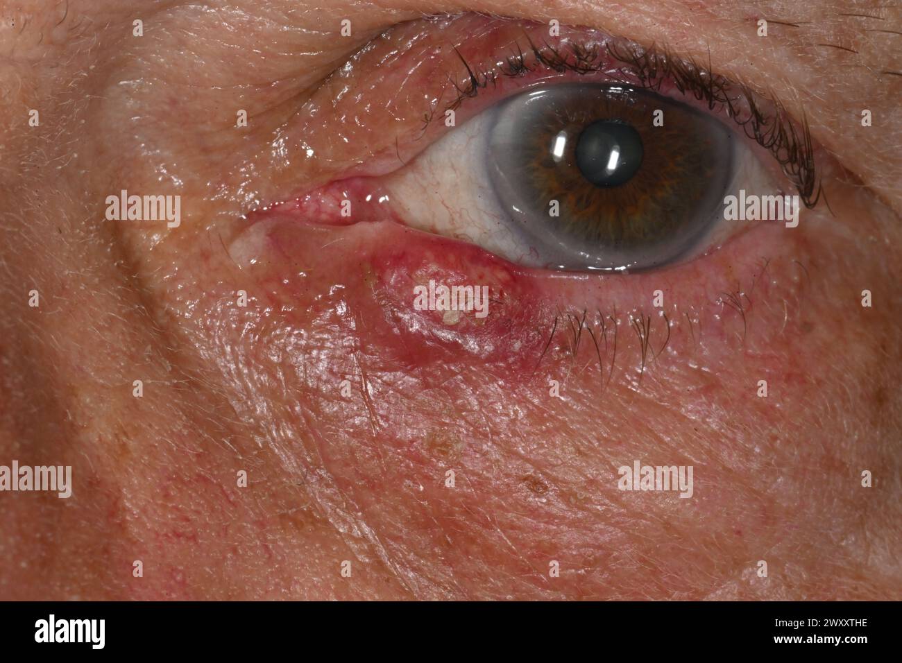 Meibomian cyst on the eyelid of a 71 year old male patient. These cysts ...