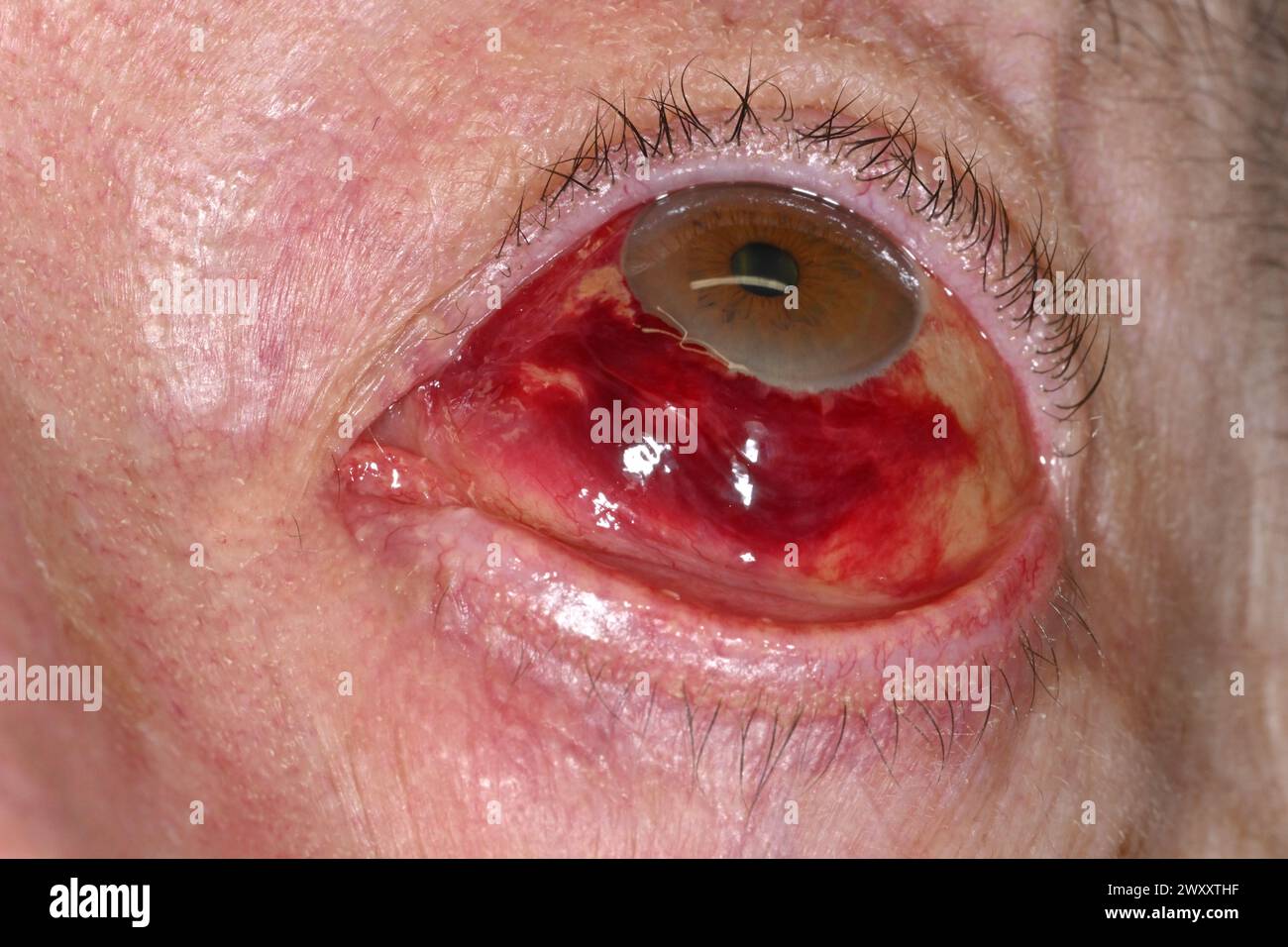 Subconjunctival haemorrhage in the eye of a 74 year old female patient ...