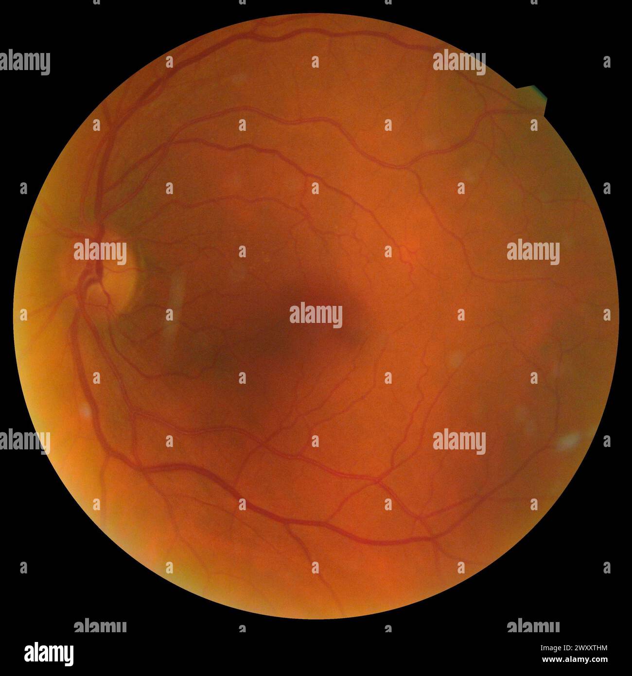 Fundoscopy scan of a healthy eye in a 63 year old female patient. The ...