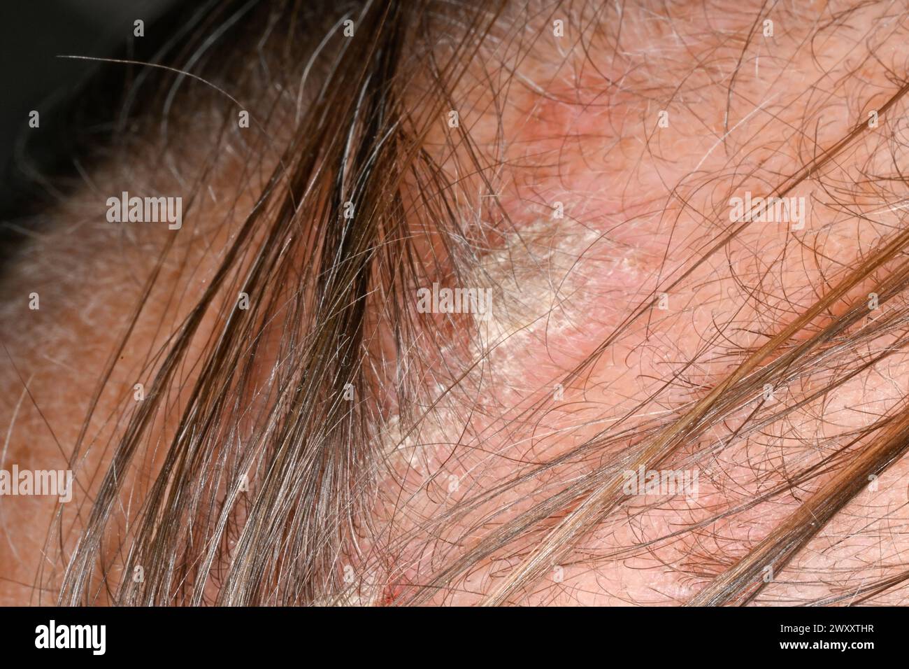 Psoriasis on the scalp of a 49 year old male patient. Psoriasis occurs ...