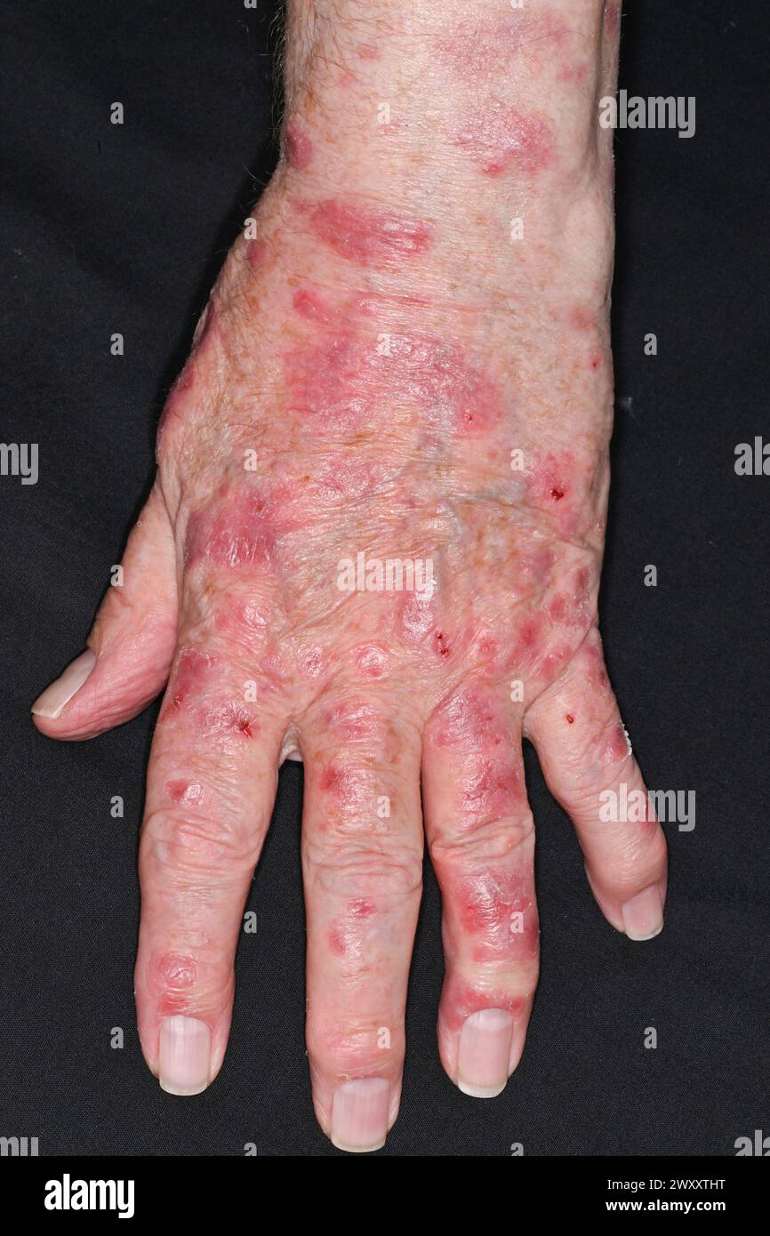 Psoriasis on the hand of an 80 year old male patient. Psoriasis occurs ...