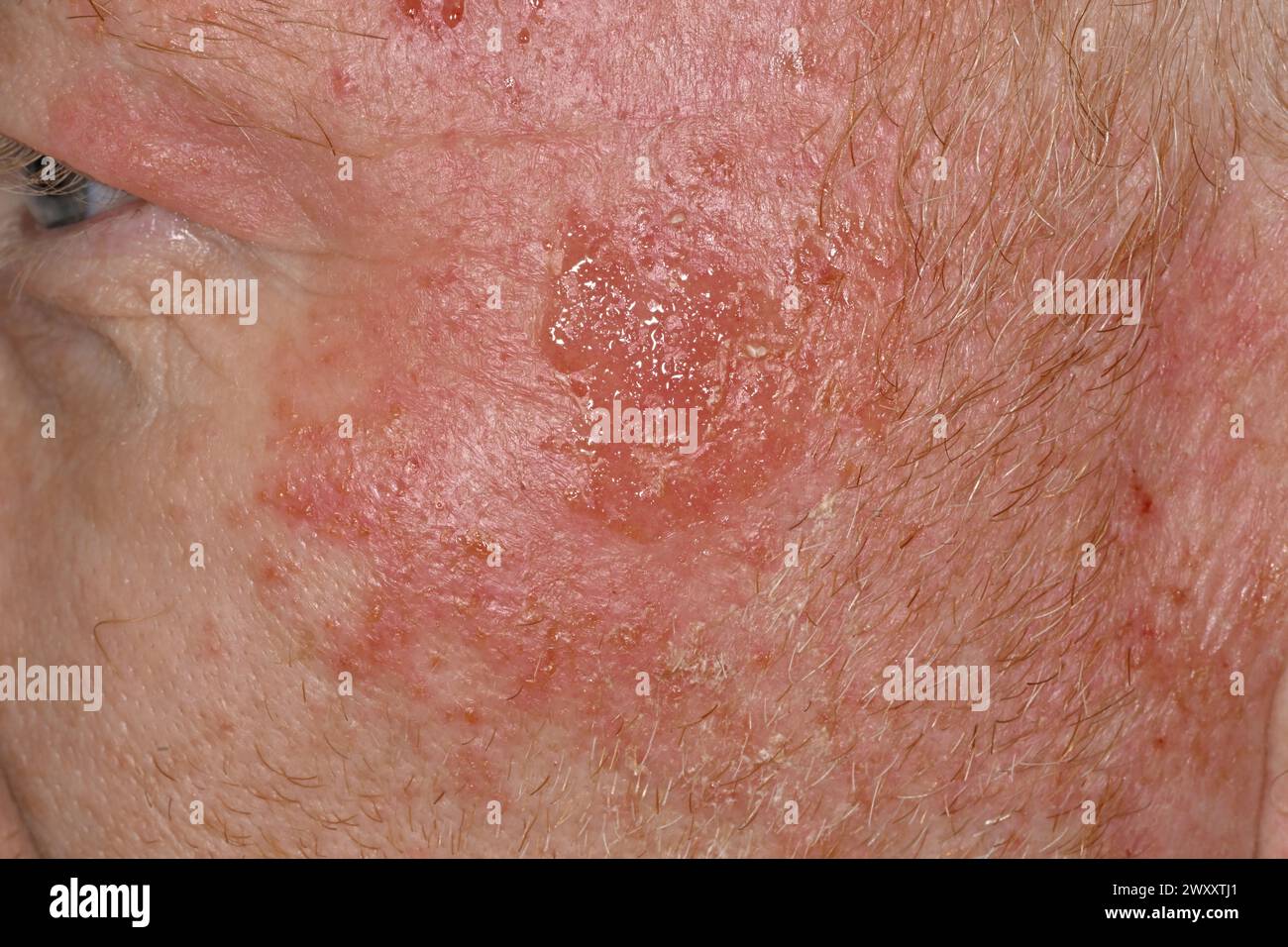 Reaction to a topical diclofenac gel on the face of a 44 year old male ...