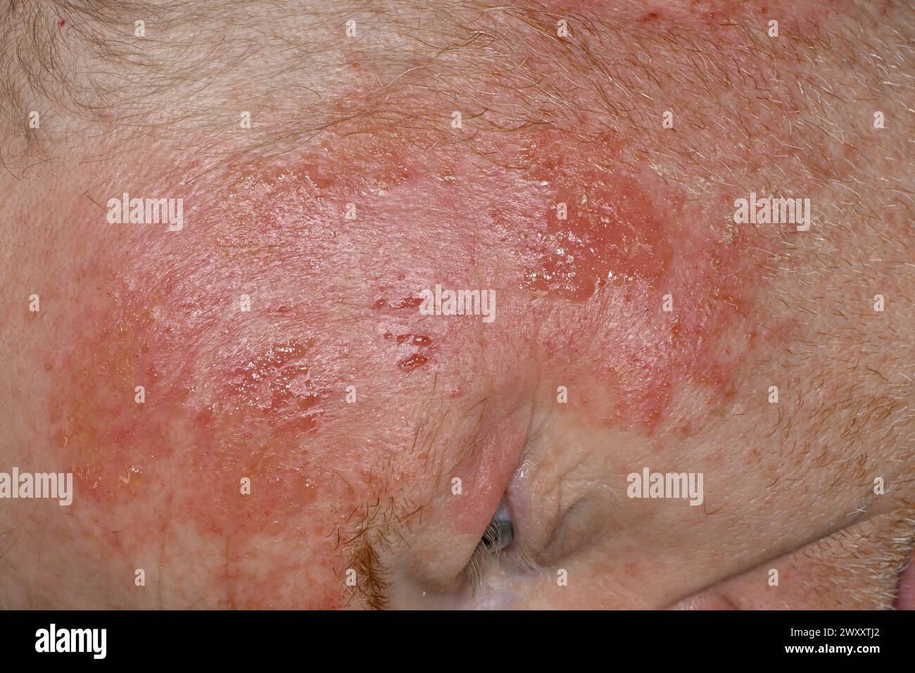 Reaction to a topical diclofenac gel on the face of a 44 year old male ...