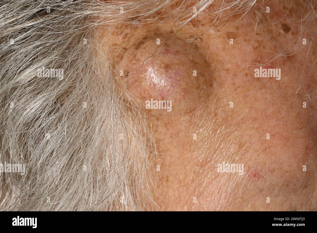 Subperiosteal haematoma on the temple of an 86 year old male patient ...