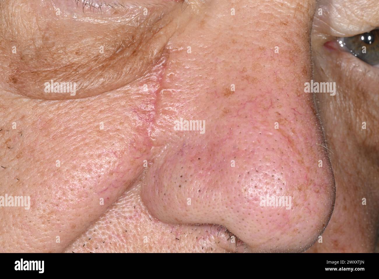 Scar following a basal cell carcinoma (BCC) excision in a 72 year old ...