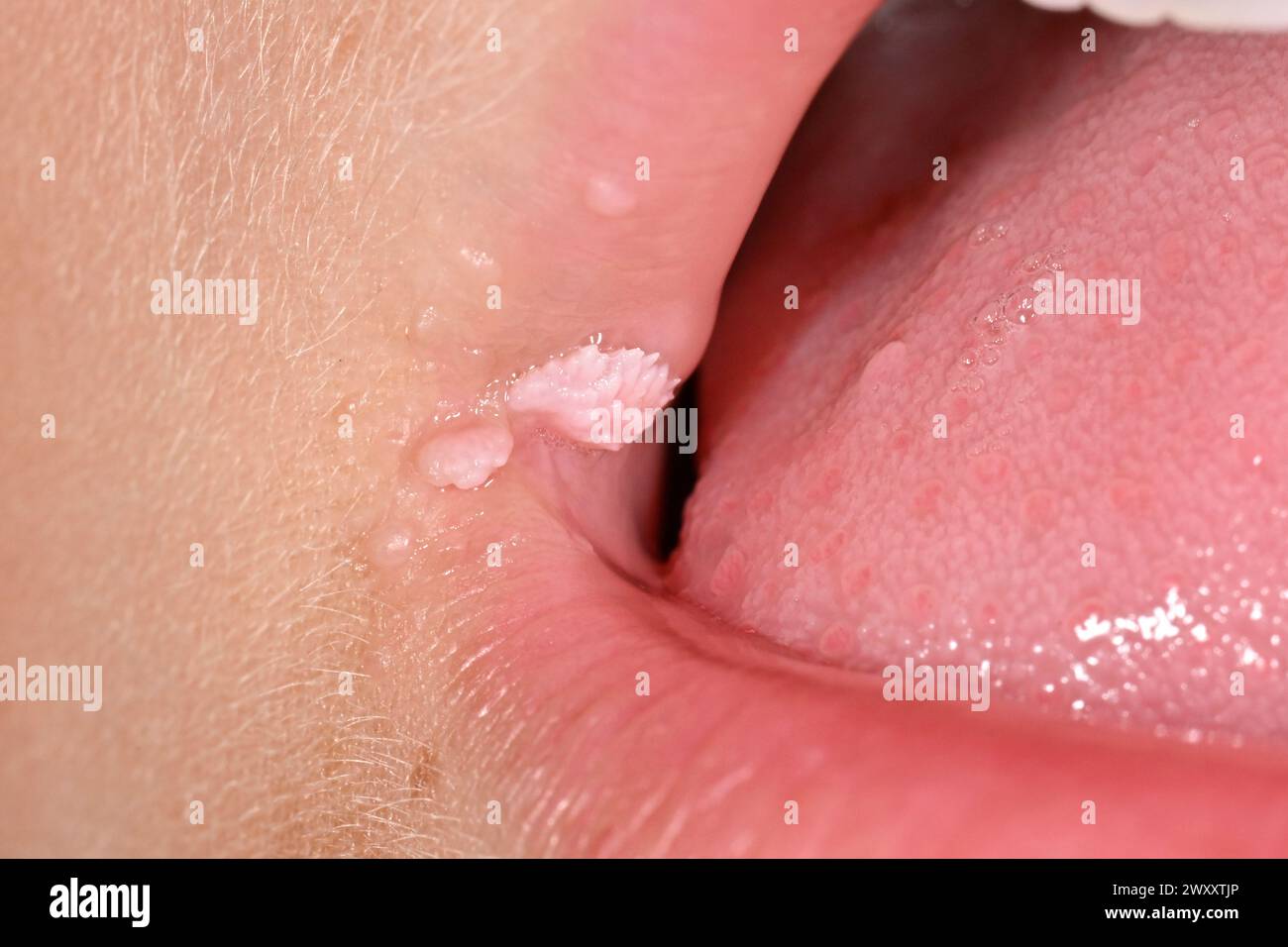White Spots On Lips Hpv Spotting Mouth Ulcers Vs. Oral Cancer Early