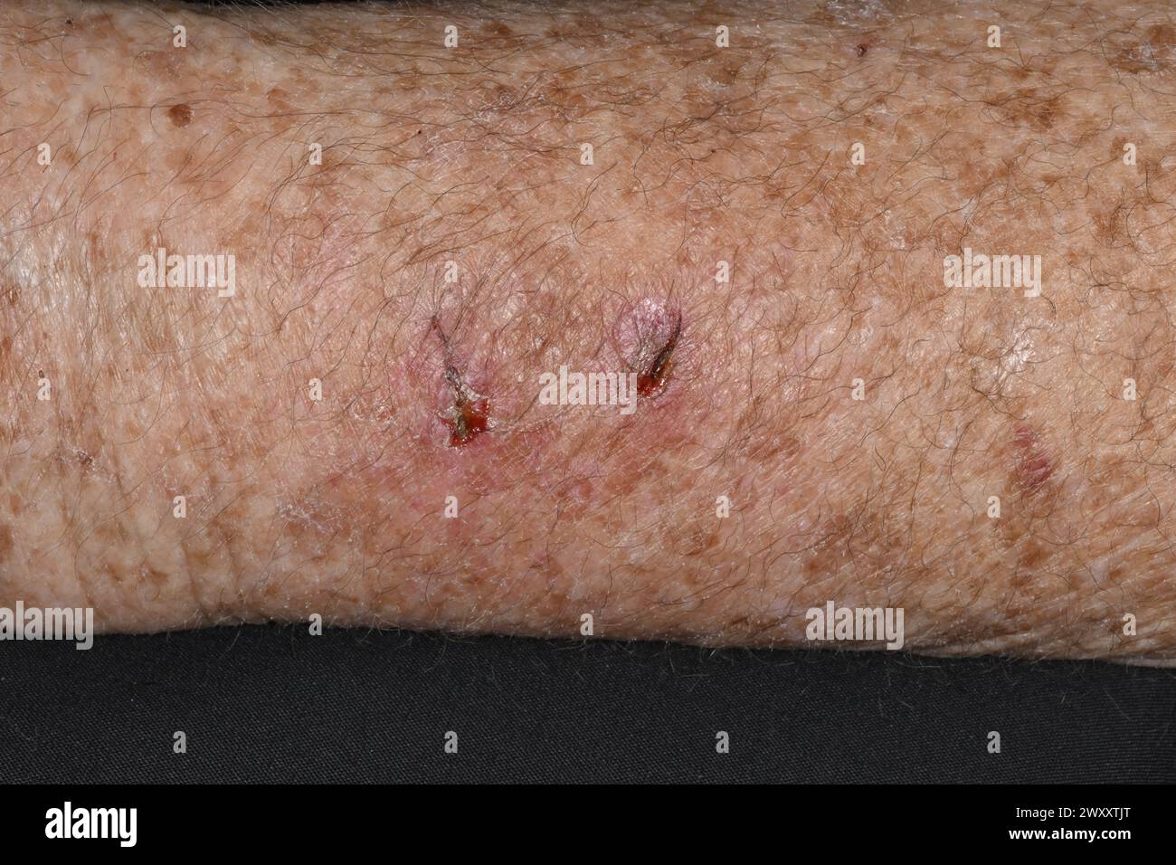 Cat scratches on the arm of a 86 year old female patient. Cat scratches ...