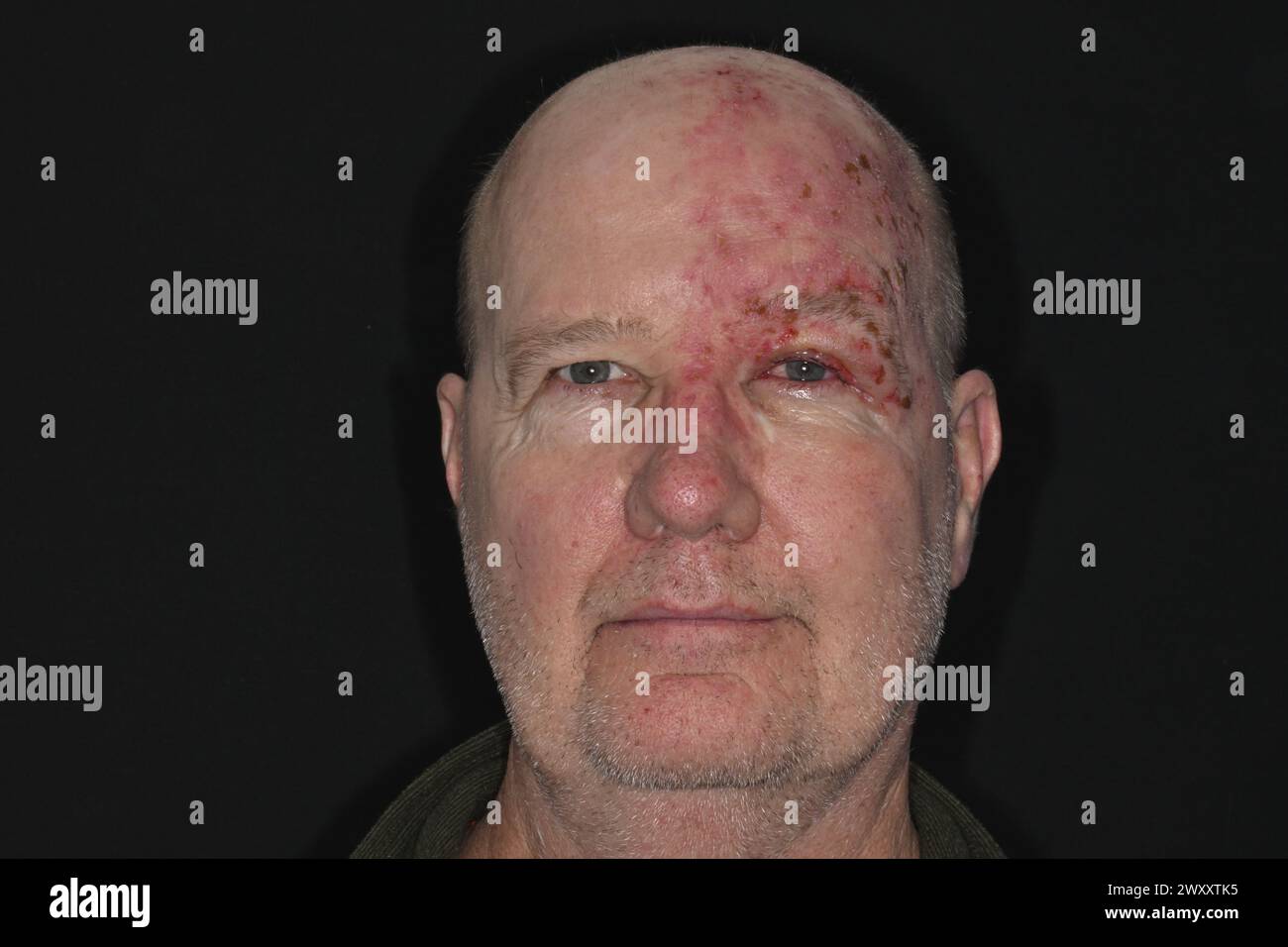 Shingles Rash Affecting The Face Of A 59 Year Old Male Patient Stock