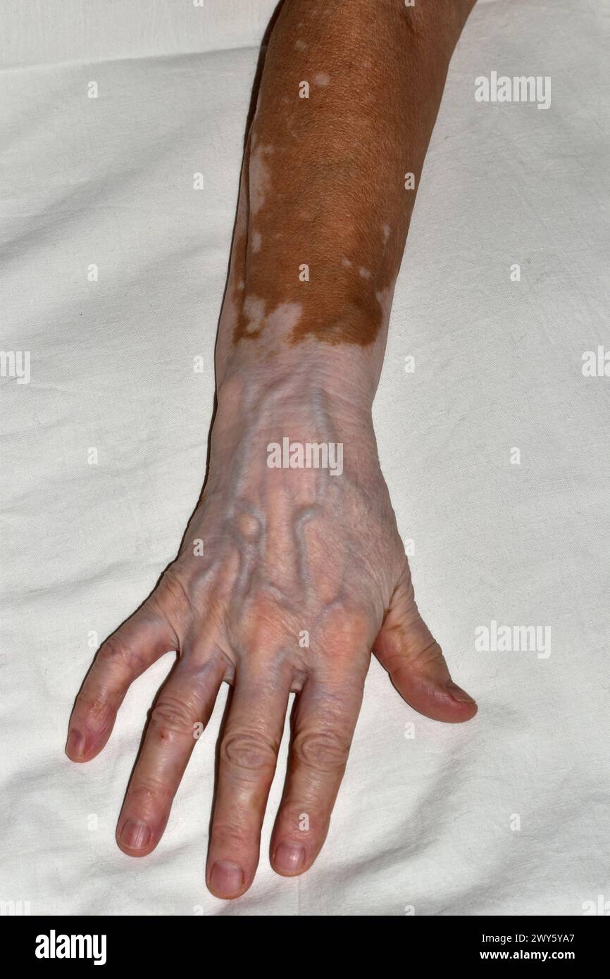 The picture shows a close-up of the right hand of an older woman ...