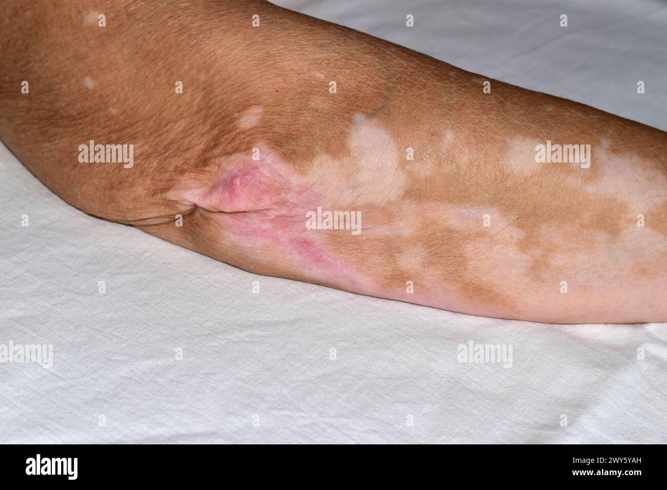 The picture shows a close-up of the elbow of the right hand of an older ...