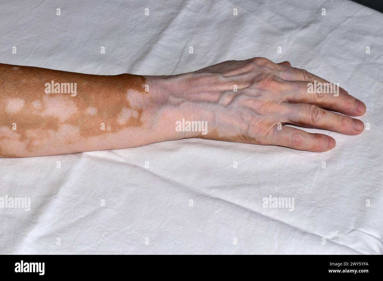 Chronic skin disease hi-res stock photography and images - Alamy