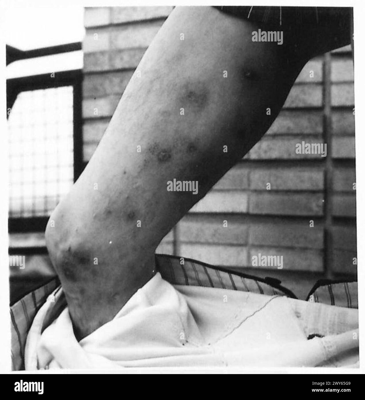 GERMAN ATROCITIES AND TORTURE AGAINST THE BELGIAN PEOPLE. - Wounds on ...