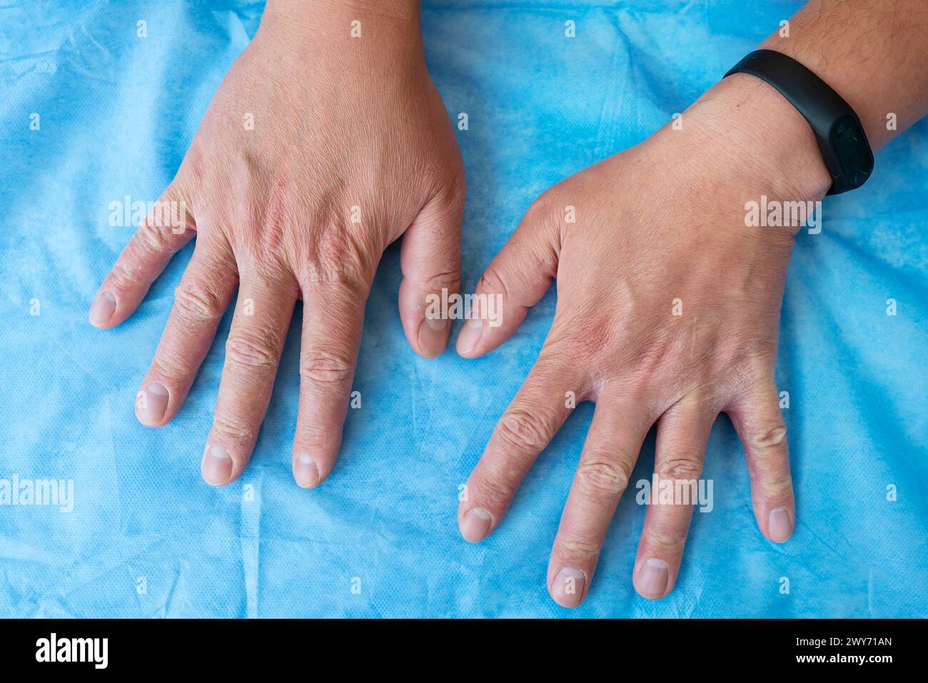 Close-up of hands with very bad skin condition, cracked skin on hands ...