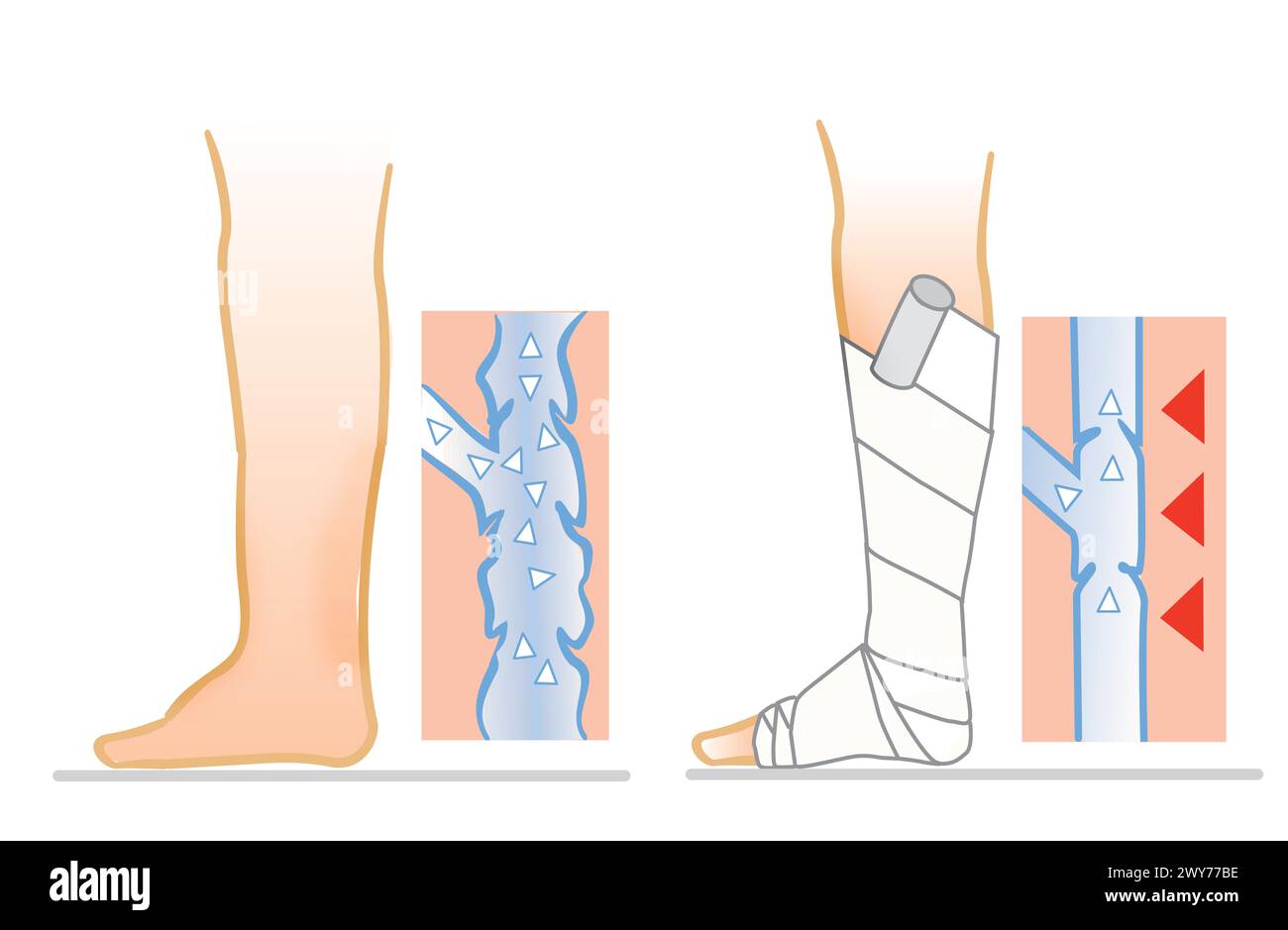 Compression Bandage For Venous Insufficiency Stock Photo - Alamy