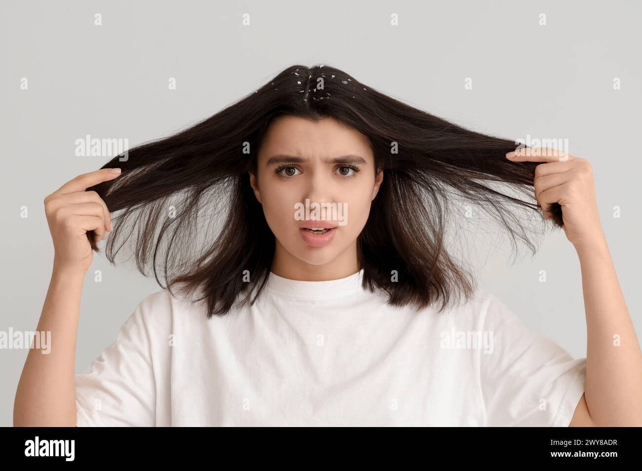 Young woman with dandruff problem on white background Stock Photo - Alamy