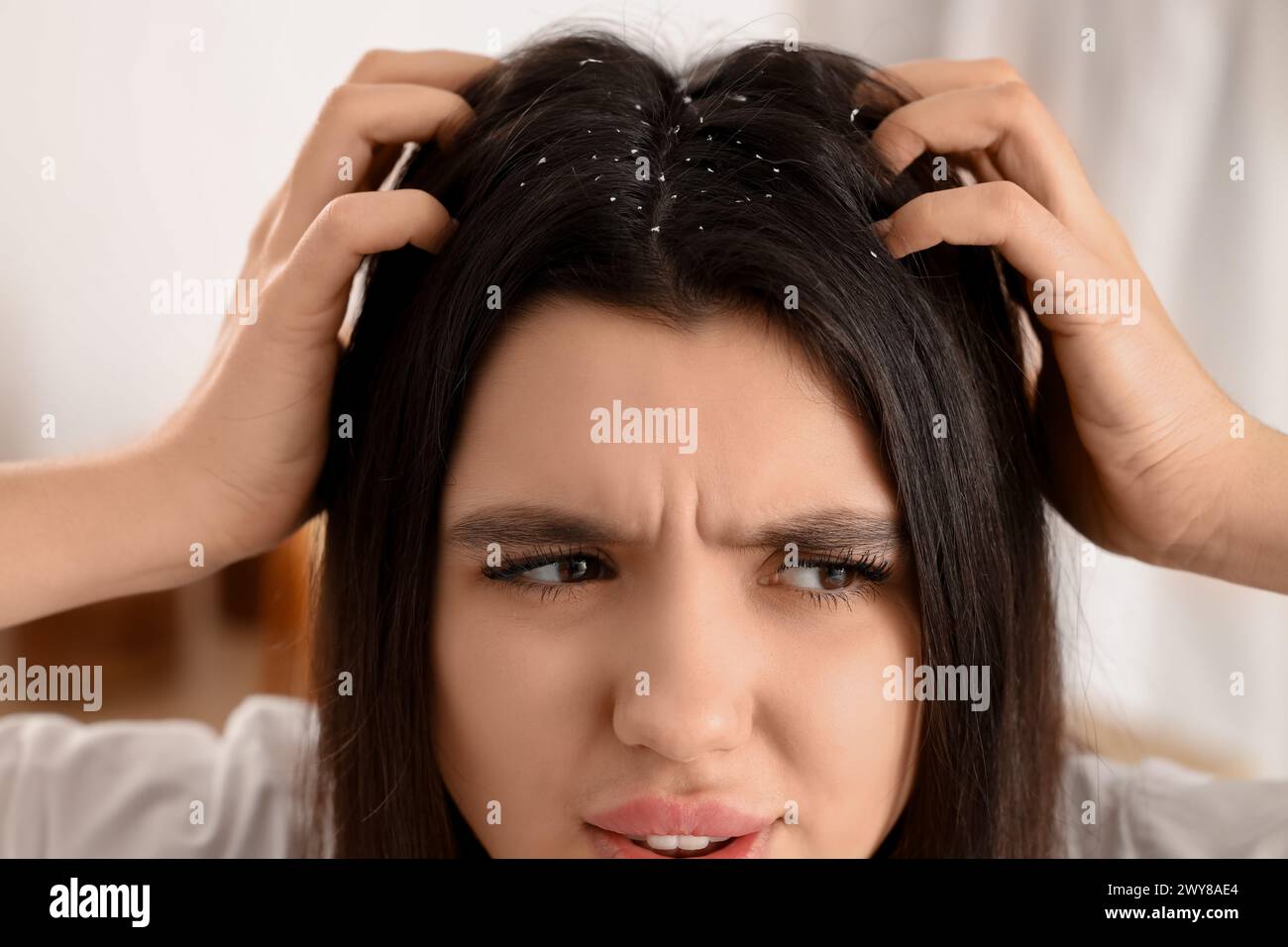 Stressed young woman with dandruff problem scratching head in light ...