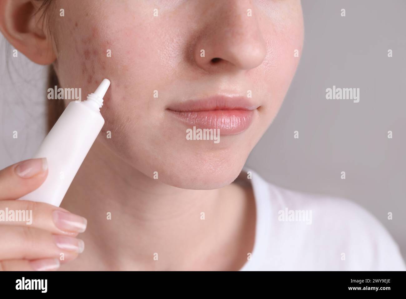 Woman blemish cream hi-res stock photography and images - Alamy