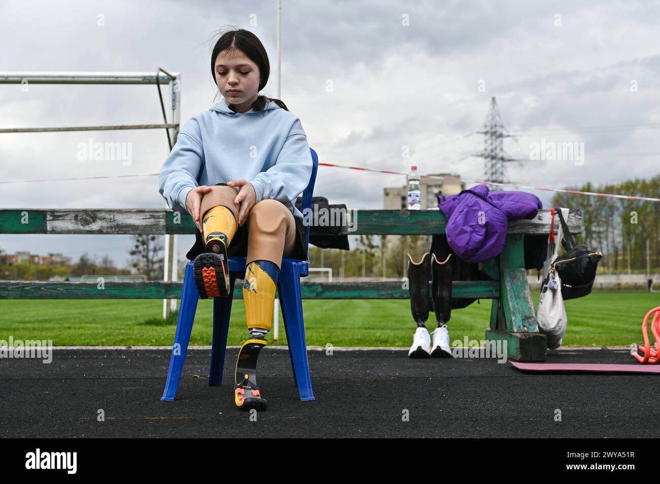 Non Exclusive: LVIV, UKRAINE - APRIL 04, 2024 - A 12-year-old Ukrainian Yana Stepanenko who lost ...