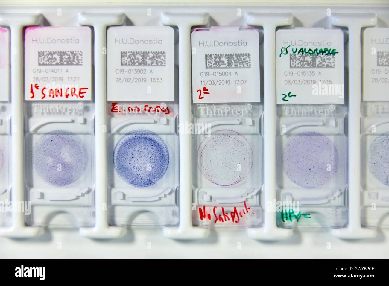 Samples, Cervical cancer screening program. The cervix is the lower ...