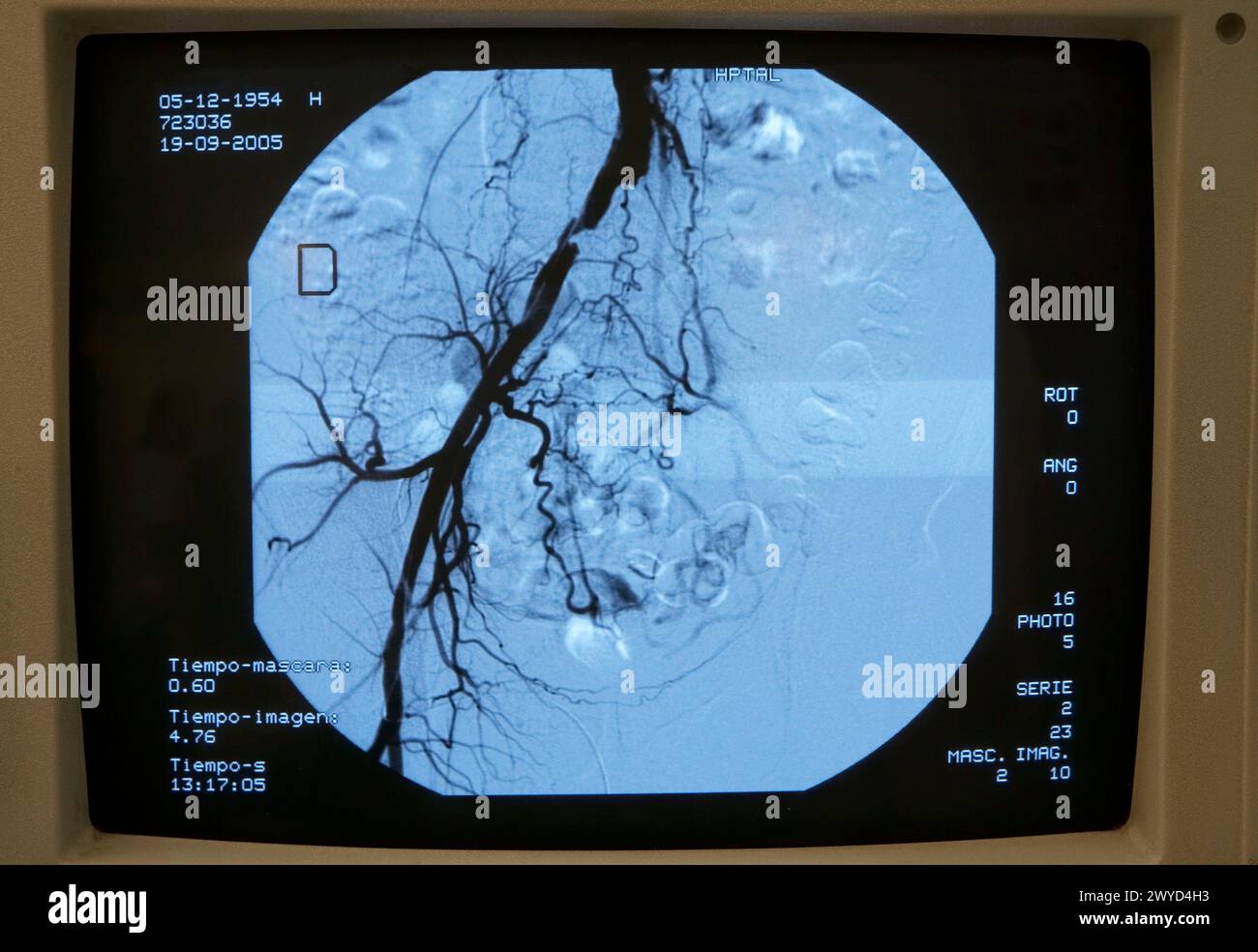 Angiography, implantation of stent or coronary endoprosthesis ...