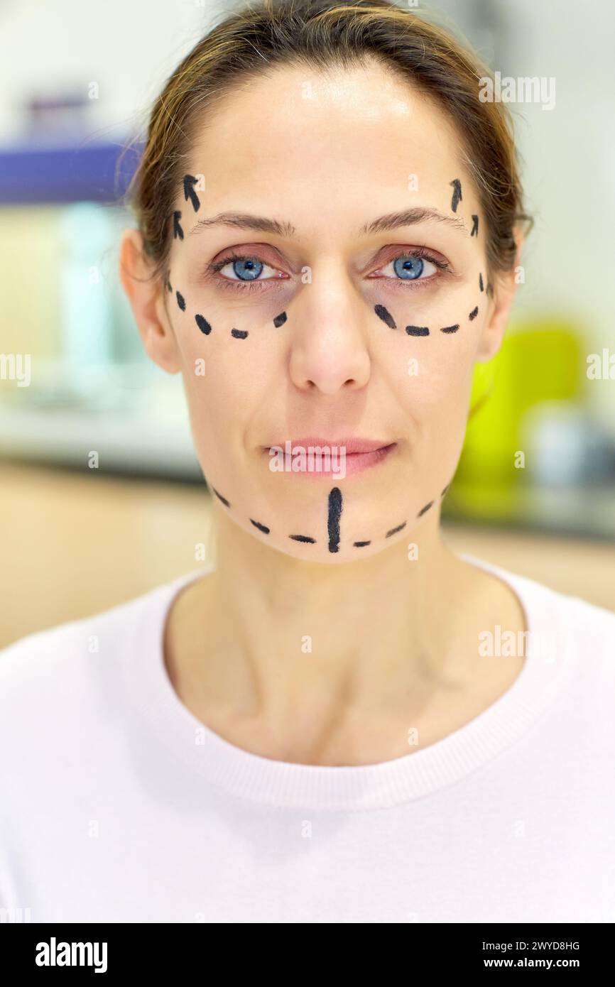 Facelift. Blepharoplasty. Rhytidoplasty. It involves stretching the ...