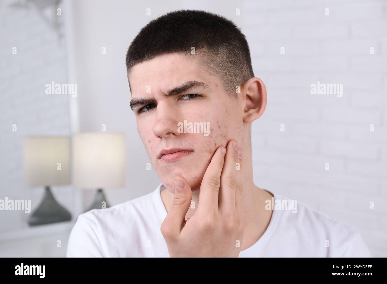 Young man touching pimple on his face indoors. Acne problem Stock Photo ...