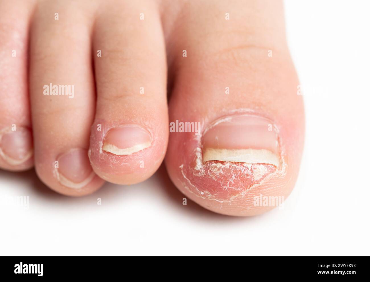 Front angle shot of a finger of a child with fungal nail infection ...