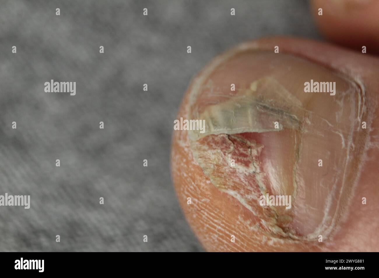 Damaged toenail plate close-up. Nail and skin diseases fungus Stock ...