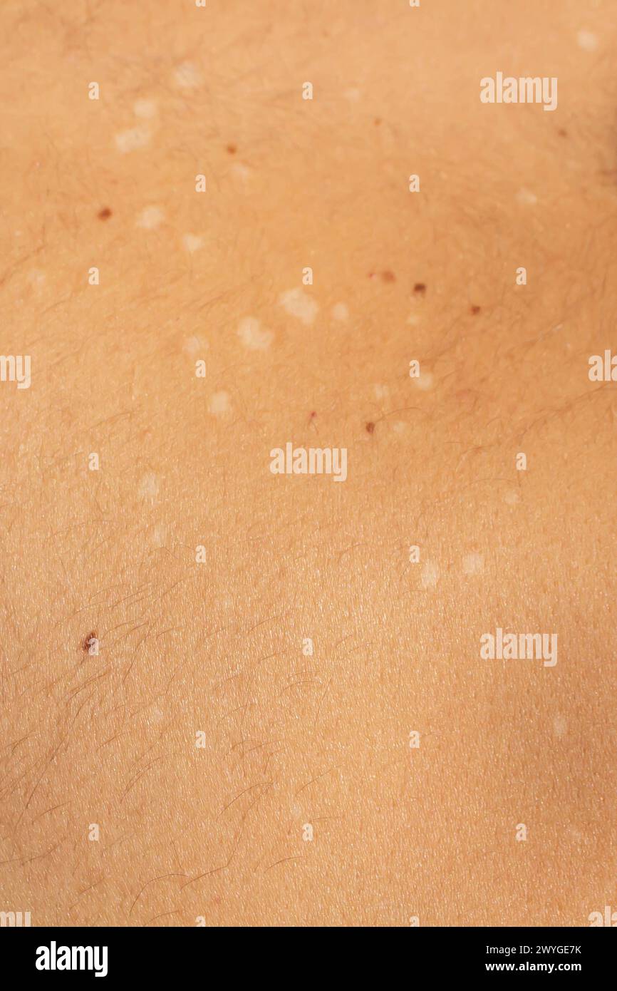 Capture the visual complexity of tinea versicolor, a common fungal skin ...