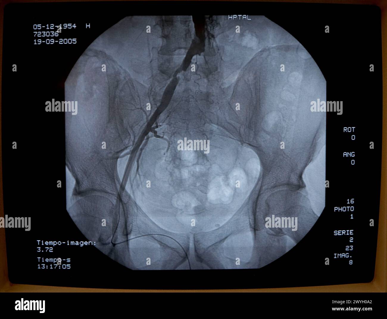 Angiography, implantation of stent or coronary endoprosthesis ...