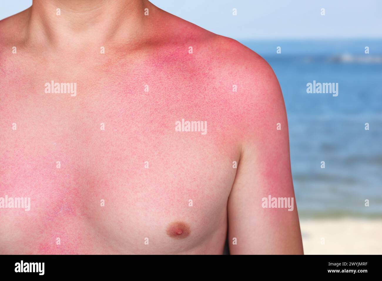 Sunburned man hi-res stock photography and images - Alamy