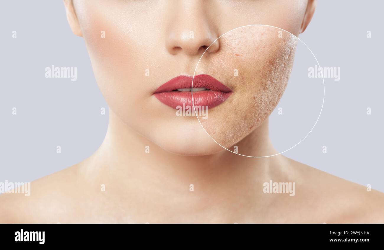 A young girl with a problem skin. Photo before and after treatment for ...