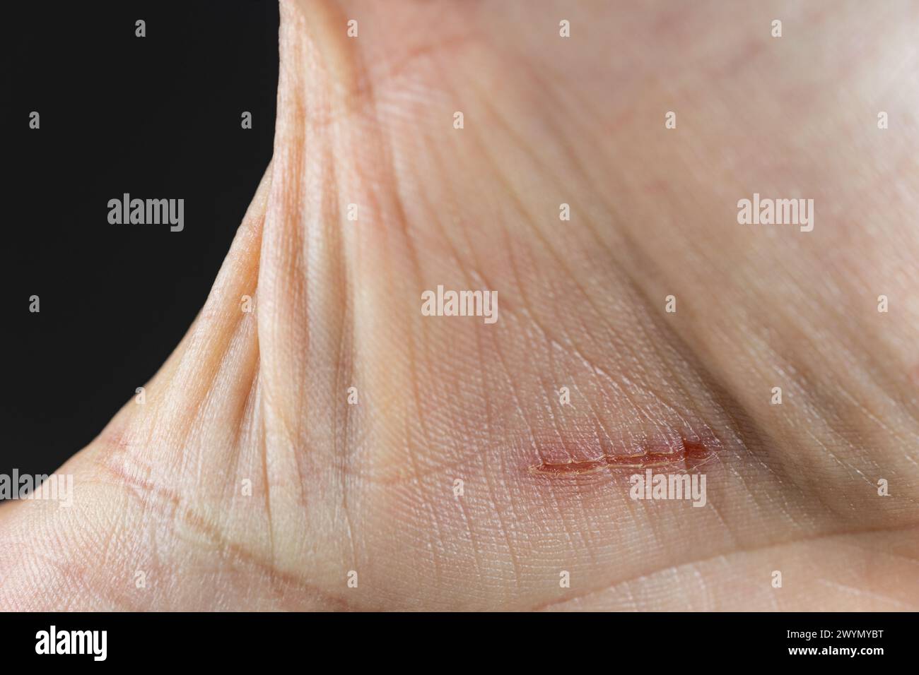 Part of human hand palm with wound caused by plant spikes Stock Photo ...